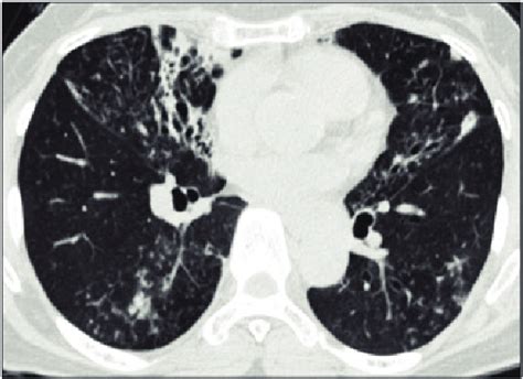 Ct Of Nodular Bronchiectatic Form Of M Intracellulare Pulmonary Download Scientific Diagram