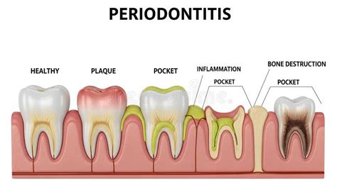 Stages Of Periodontitis Illustrated By Different Tooth Conditions Stock Illustration