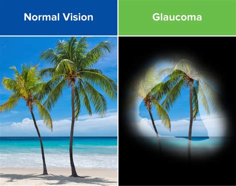 What You Need To Know About Diabetic Eye Disease Acuity Eye Group