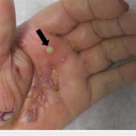 Microscopic Examination Of The Initial Section From The Skin Lesion