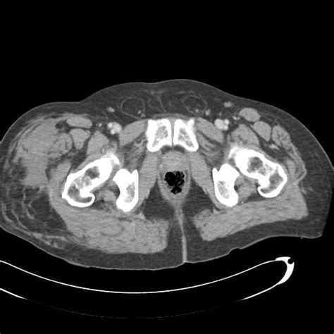 Radiopaedia Case Gluteal Hematoma And Lumbar Transverse Fracture In