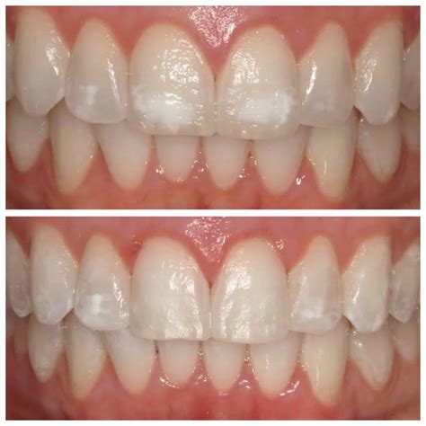 White Spot Lesions Archives Scottsdale Dental Bottega