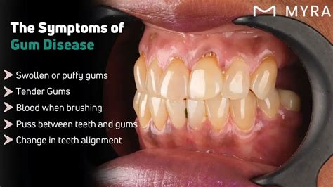Gum Disease Symptoms Treatment Causes