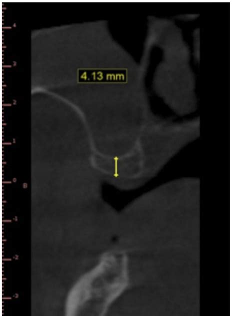 Figure 3 Maxillary Sinus Floor Elevation Using