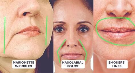 Nasolabial Fold Best Treatments For Nasolabial Folds And Marionette