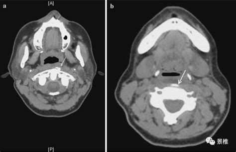 急性颈长肌钙化性肌腱炎！ 德医医学 助力医学教育发展！