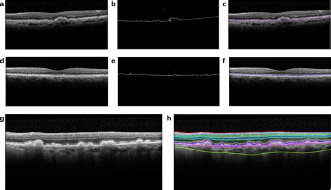 Segmentation Of Drusen Rpd And Eleven Retinal Layers On Sd Oct