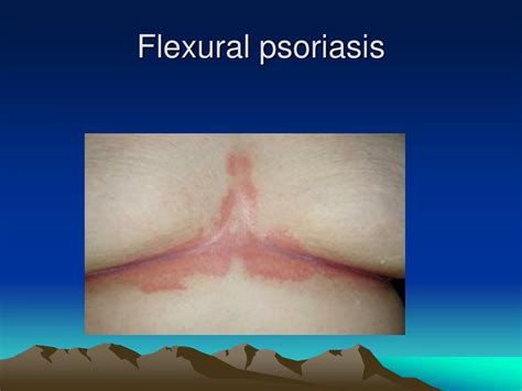 Ppt Psoriasis Powerpoint Presentation Free Download Id3042608
