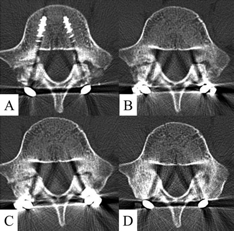 Postoperative Axial Computed Tomography Ct Scan Showing Compression Download Scientific