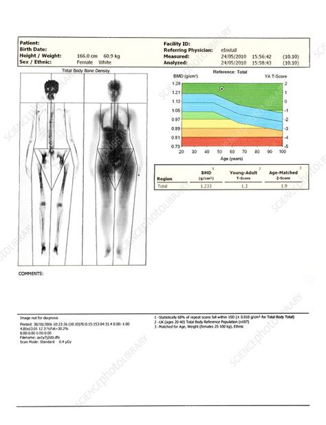 Bone Density Scan Stock Image C0197429 Science Photo Library