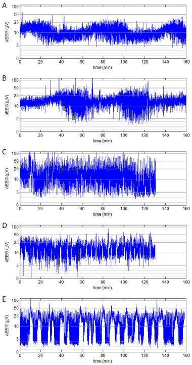 Characteristic Appearance Of Aeeg Tracings With Different Scores Of