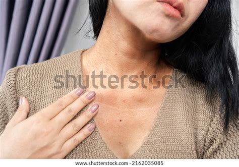 Dark Spots On Neck Female Over 441 Royalty Free Licensable Stock