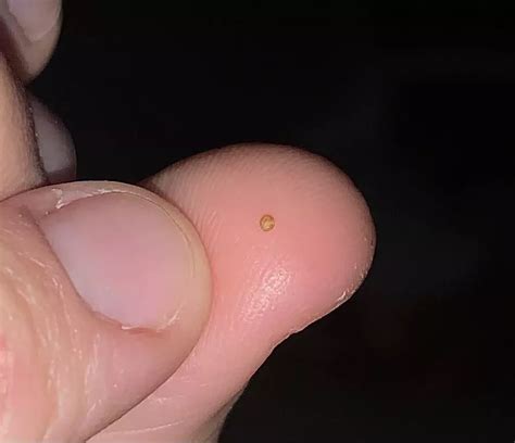 Have Had A Weird Angry Bump Inside My Ear Canal For The Past Few Days