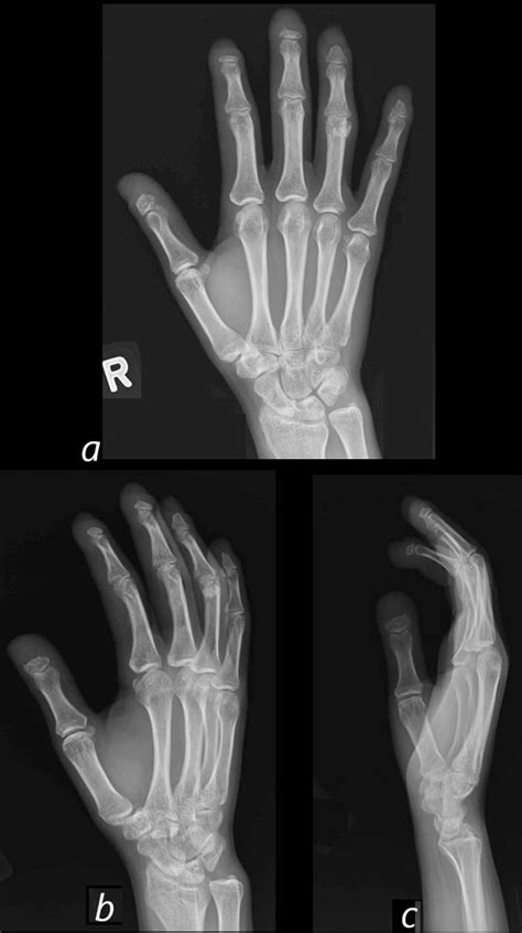 272lu Scleroderma Cellular Nsip Acro Osteolysis The Common Vein