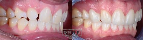 Smile Makeover Missing Lateral Incisor Dental Veneers