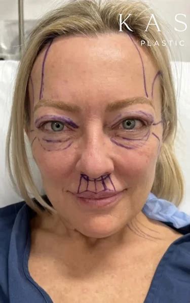 What Is Nasal Septal Deviation Or “deviated Septum” Kassir Plastic