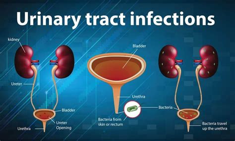 Uti Vs Std By Palme Rinoble Jun 2024 Medium