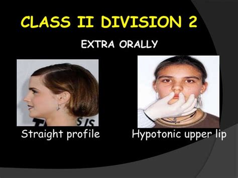Angles Class Ii Malocclusion Ppt