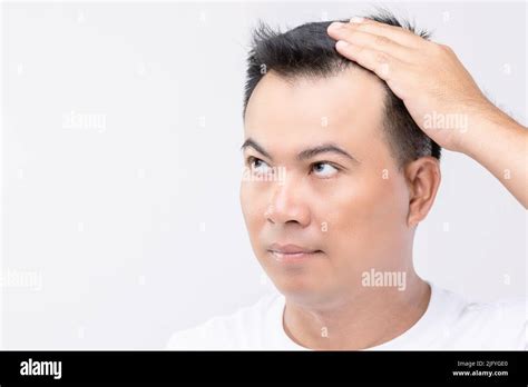 Portrait Asian Man With Worry Feeling And Touching On His Head To Show Bald Head Or Glabrous