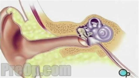 Myringotomy Insertion Of Tube Surgery Preop® Patient Engagement And