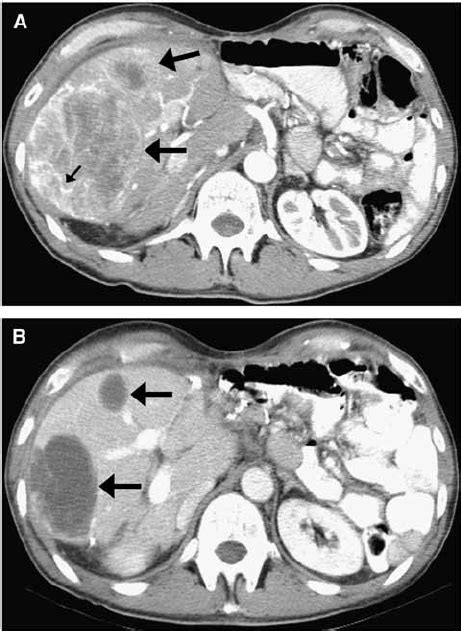 Gastrointestinal Stromal Tumorgist Gastrointestinal Stromal Tumor