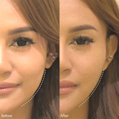 Wajah Tirus Dan Segar Tanpa Repot Insta Beauty Center