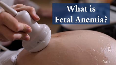 How Fetal Anemia Is Diagnosed And Monitored News Yale Medicine