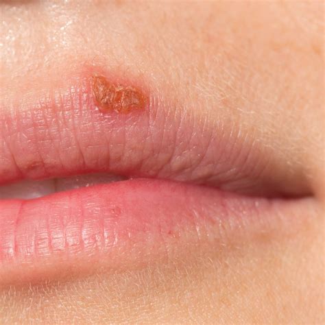What Is Oral Herpes Infection Or Cold Sores Healthtips By Teleme