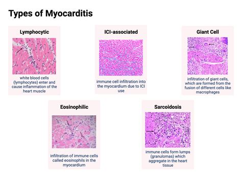 Myocarditis Center Ucsf Cardiology