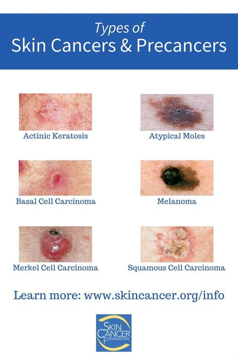 Different Types Of Skin Cancer On Face Cancerwalls