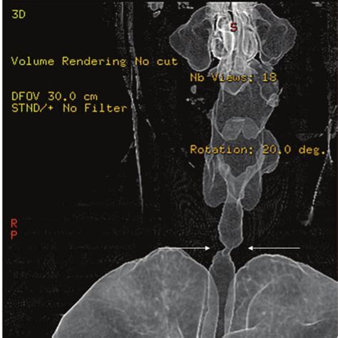 Flow Volume Loop Revealing Fixed Upper Airway Obstruction Download