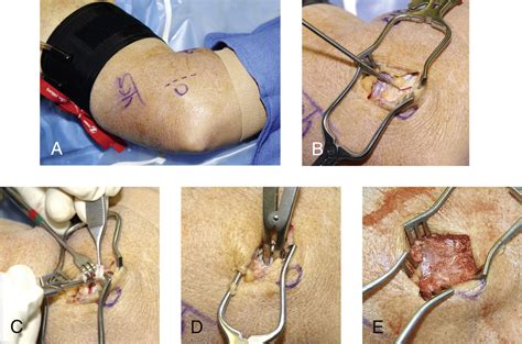 Open Treatment Of Medial And Lateral Epicondylitis Musculoskeletal Key