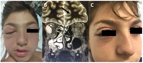 A A 13 Year Old Patient With Acute Maxillary Sinusitis An Orbital Download Scientific