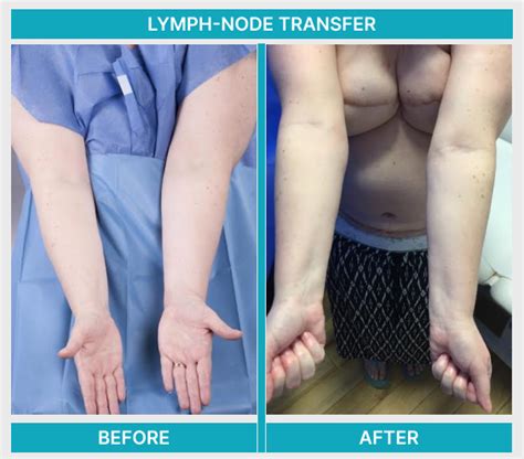 Lymph Node Transfer Treatment In Uk Dr Damir