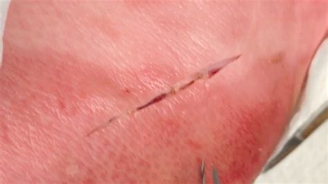 Subcuticular Suture