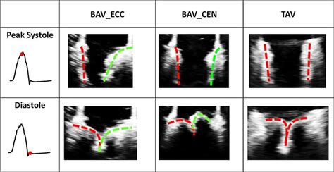 Aortic Valve Leaflets