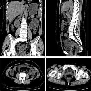 Ct Plain Scan Of The Pelvic And Abdominal Cavity Download Scientific