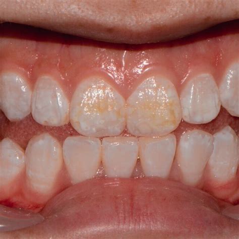 Teeth With Severe Dental Fluorosis Were Treated With Microabrasion And