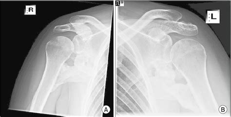 Preoperative Roentgenogram Of The Right Shoulder Joint A And The Left Download Scientific