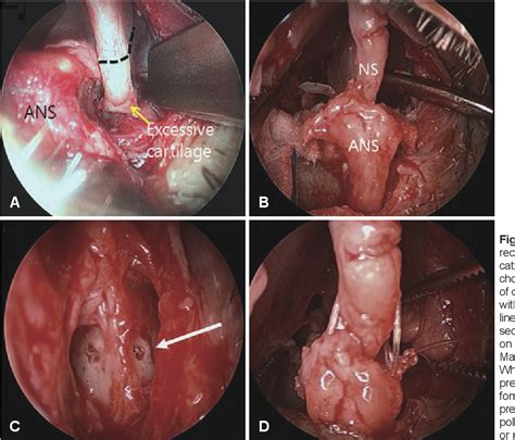 Figure 2 From Correction Of Caudal Septal Dislocation Or Subluxation