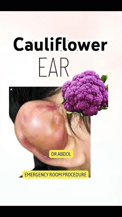 Complete Guide Cauliflower Ear Drainage And Proper Dressing Youtube
