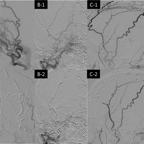 Endovascular Onyx Embolization Of Dural Arteriovenous Fistulas A