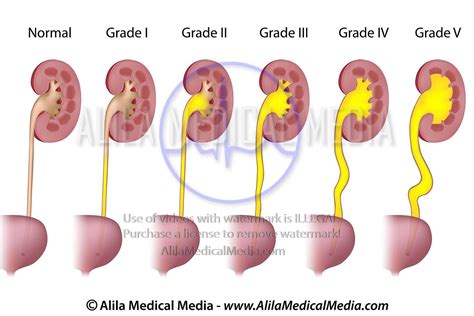 Alila Medical Media Reflux Nephropathy Grading Medical Illustration