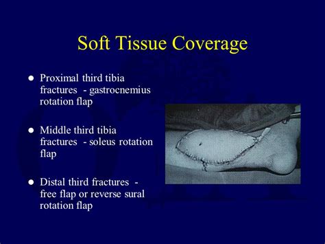 Open Fractures Of The Tibial Diaphysis Ppt Video Online Download