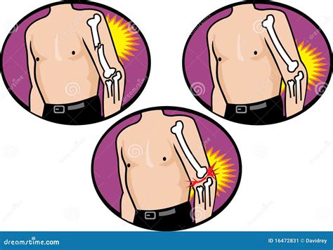 Fractures Stock Vector Illustration Of Clip Dislocation 16472831