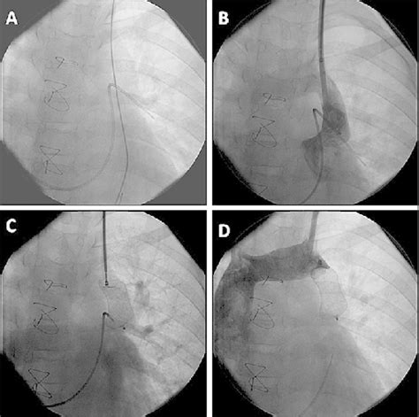 Fluoroscopy And Cine Angiogram Steps Of Transcatheter Closure Of Patent