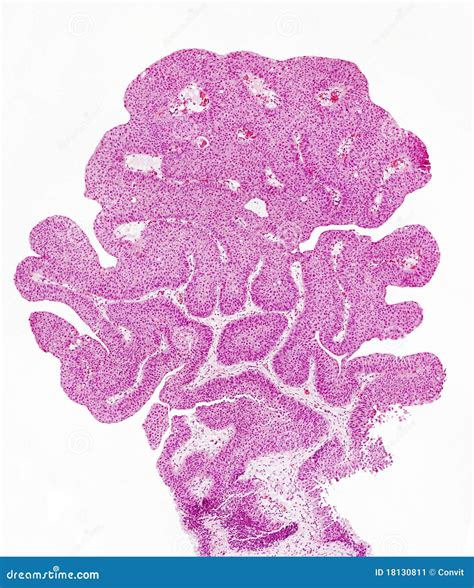 Bladder Polyp Stock Image Image Of Investigation Bladder 18130811