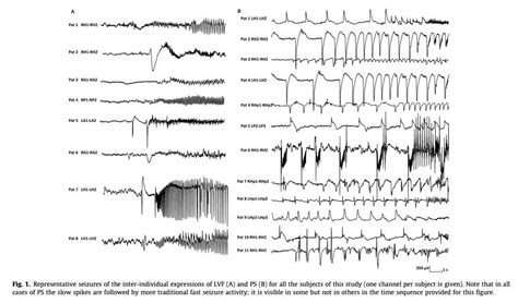 Eishi Asano On Linkedin Tle Epilepsy Eeg Clinicalneuroph