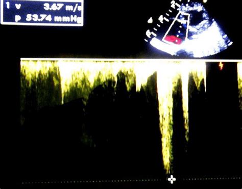 Doppler Echocardiography Showing Ventricular Outflow Gradient Download Scientific Diagram