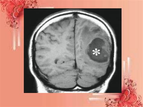 Brain Abscess Pptx